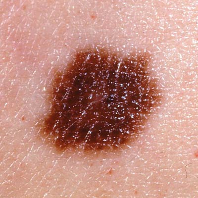 Dysplastic nevus - What Skin Cancer Looks Like - Health.com